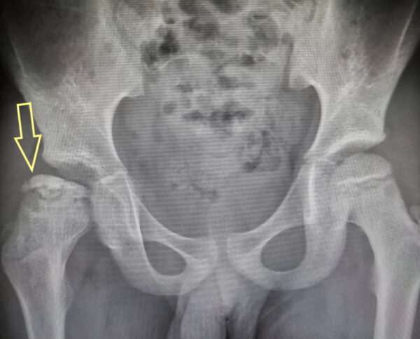 Managing Teenager Hip Pain and Hip Apophysitis - Sport Doctor London