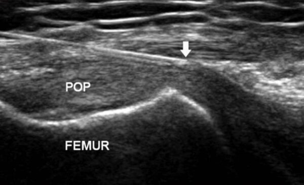 What is Popliteus Tendinitis and How to Treat It? - Sport Doctor London