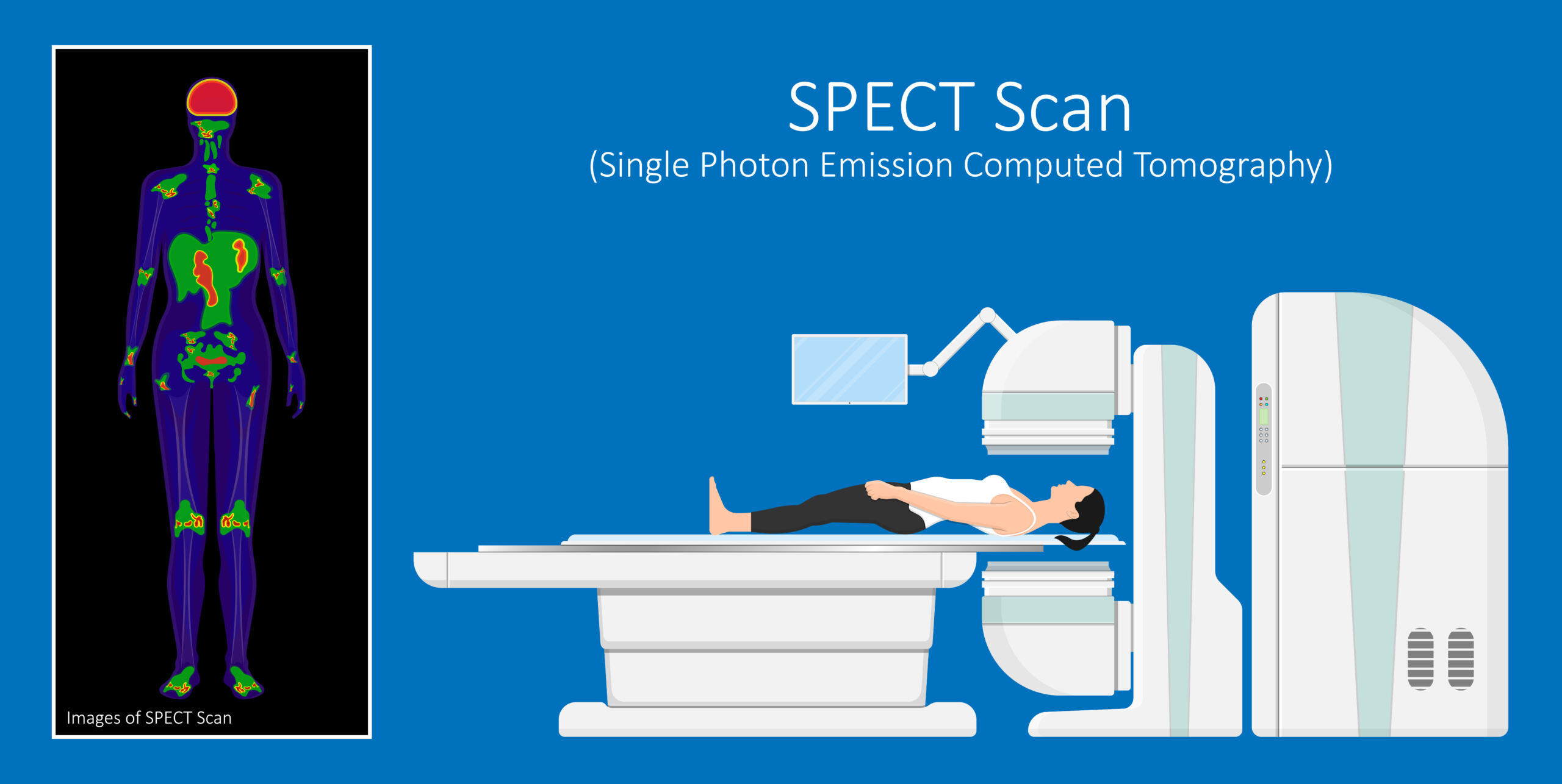 SPECT CT bone scan: when and why we use it in sports medicine - Sport ...